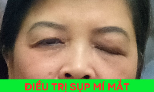 Điều trị sụp mí mắt